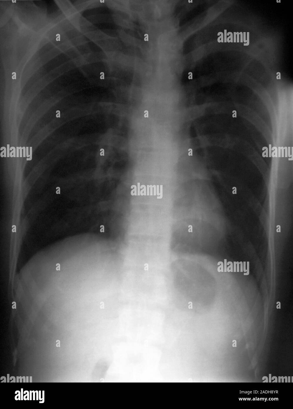 Chronic bronchitis. X-ray of the lungs of a person with chronic ...
