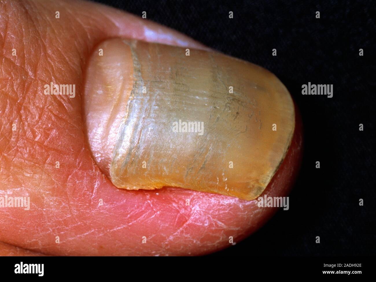 Yellow nail as a symptom of bronchiectasis in a 41-year-old man ...