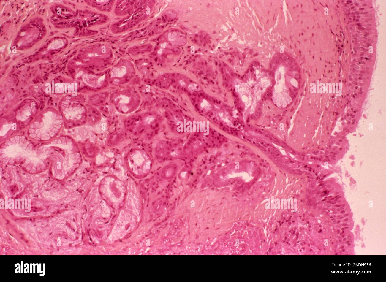Bronchitis. Light micrograph of a section through lung tissue affected ...