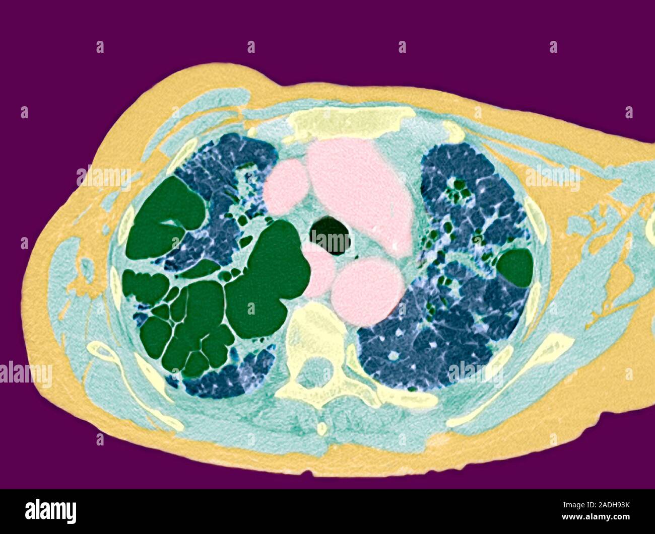 Lung disorder. Coloured axial (horizontal) CT (computed tomography ... Lung disorder. Coloured axial (horizontal) CT (computed tomography ...