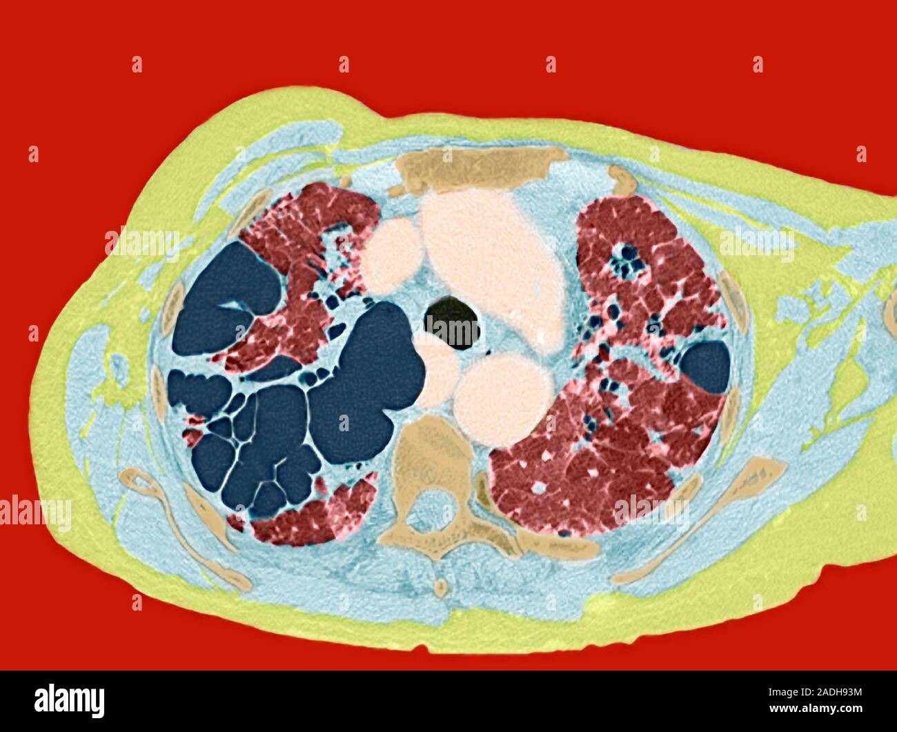 Lung disorder. Coloured axial (horizontal) CT (computed tomography ... Lung disorder. Coloured axial (horizontal) CT (computed tomography ...