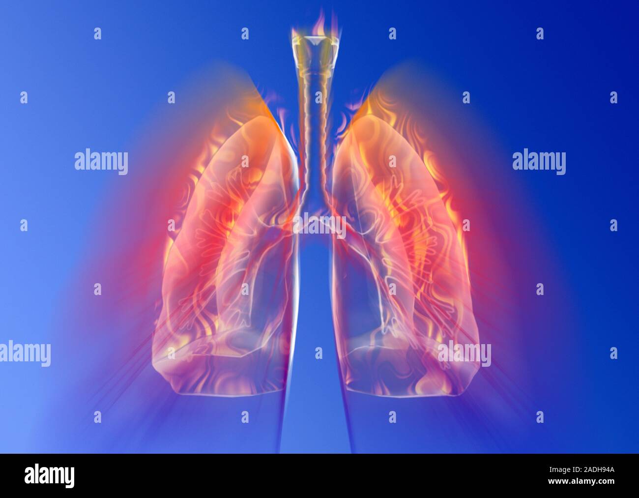 Inflamed lungs. Conceptual computer image of a pair of lungs with ...