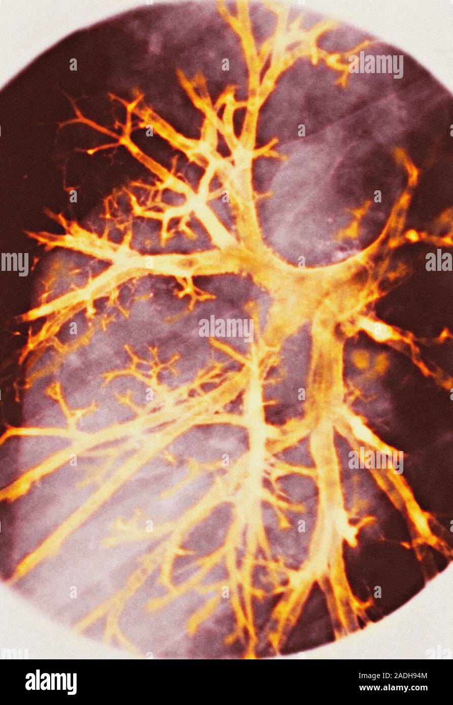 Bronchitis. Coloured bronchography (X-ray) of swollen bronchioles ...