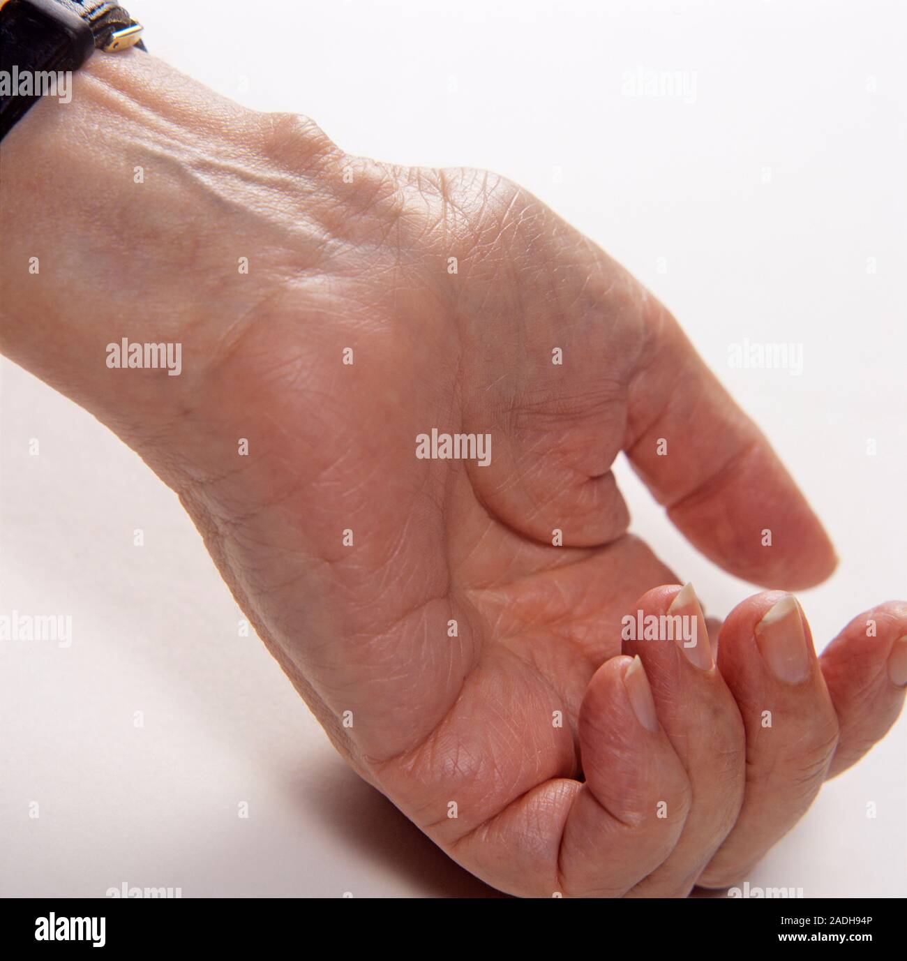 Inflamed bursa on the wrist of an elderly woman. A bursa is a fluid ...