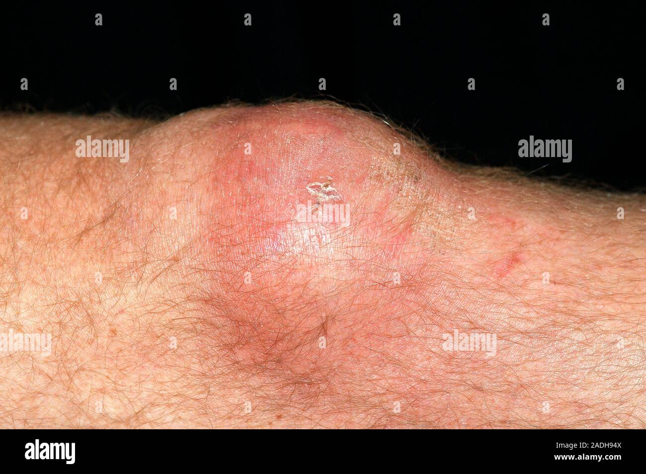 Swollen Knee After Operation 40 Year Old Mans Swollen Knee Reddened Area 2 Weeks After A