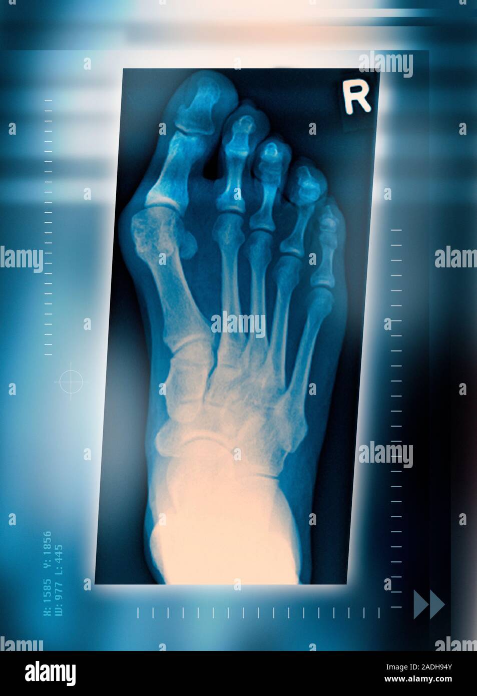 Bunion. Coloured X-ray of a bunion on a patient's foot. A bunion ...