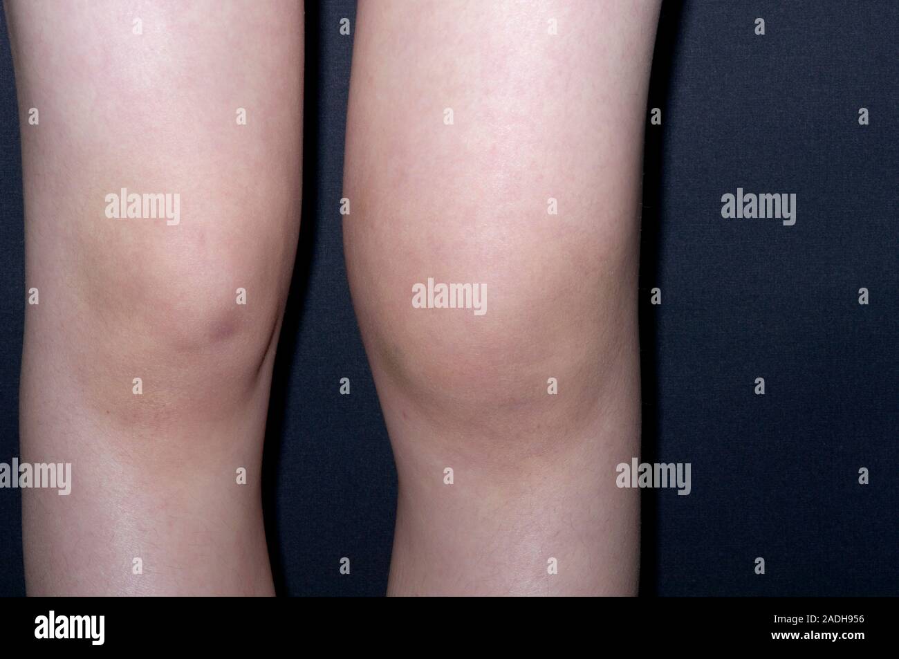 Bursitis of the knee of a 14 year old girl. The condition has led to ...