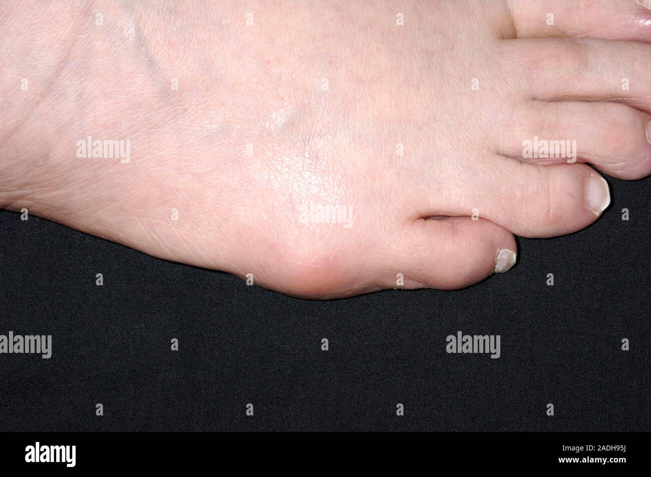 Bunionette on a 53 year old woman's foot. A bunionette, or tailor's ...