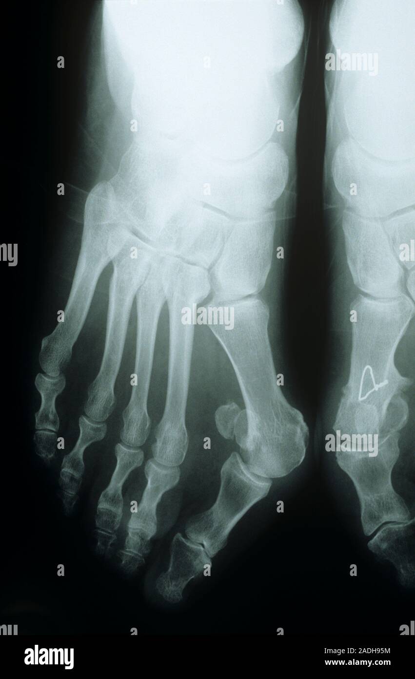 Bunion. X-ray of a bunion on a patient's foot. A bunion (hallux vulgas ...