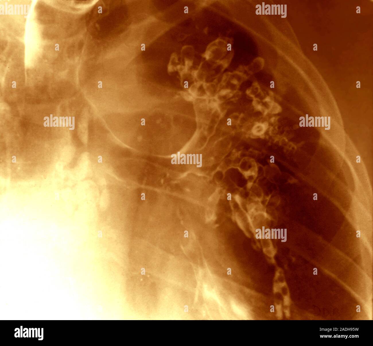 Bronchiectasis. Coloured bronchogram (X-ray) of the lung of a patient ...
