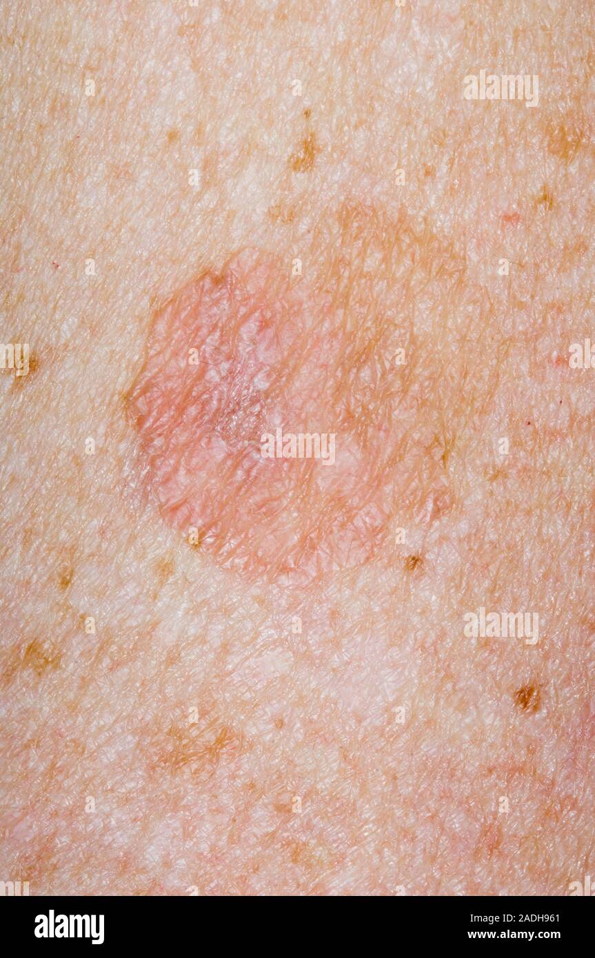 Bowen's disease on skin of an 55 year old women. Bowen's disease, also ...