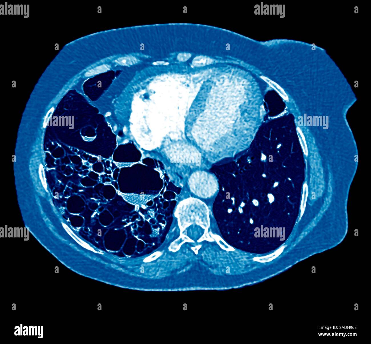 Lung disorder. Coloured axial CT (computed tomography) scan through the ... Lung disorder. Coloured axial CT (computed tomography) scan through the ...