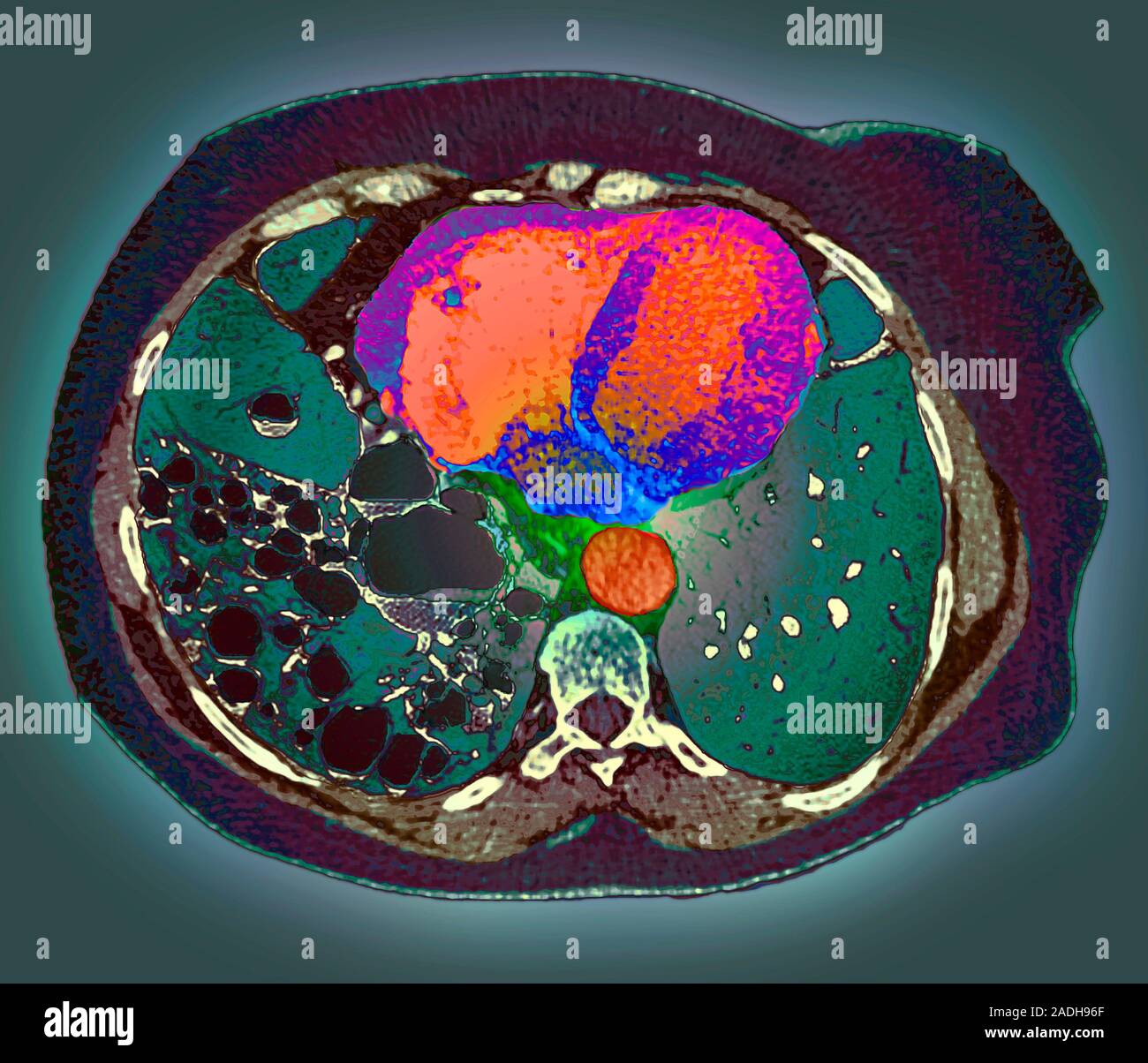 Lung disorder. Coloured axial CT (computed tomography) scan through the ... Lung disorder. Coloured axial CT (computed tomography) scan through the ...