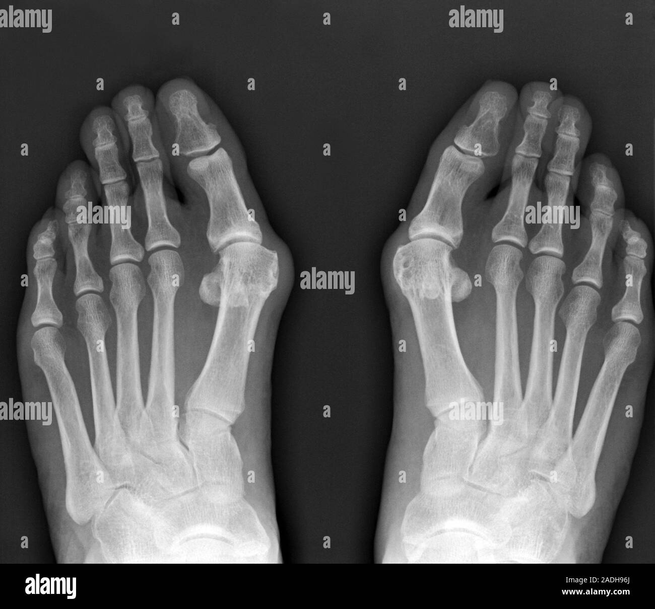 Bunions. X-ray of bunions (hallux vulgas) on the feet of a 69-year-old ...