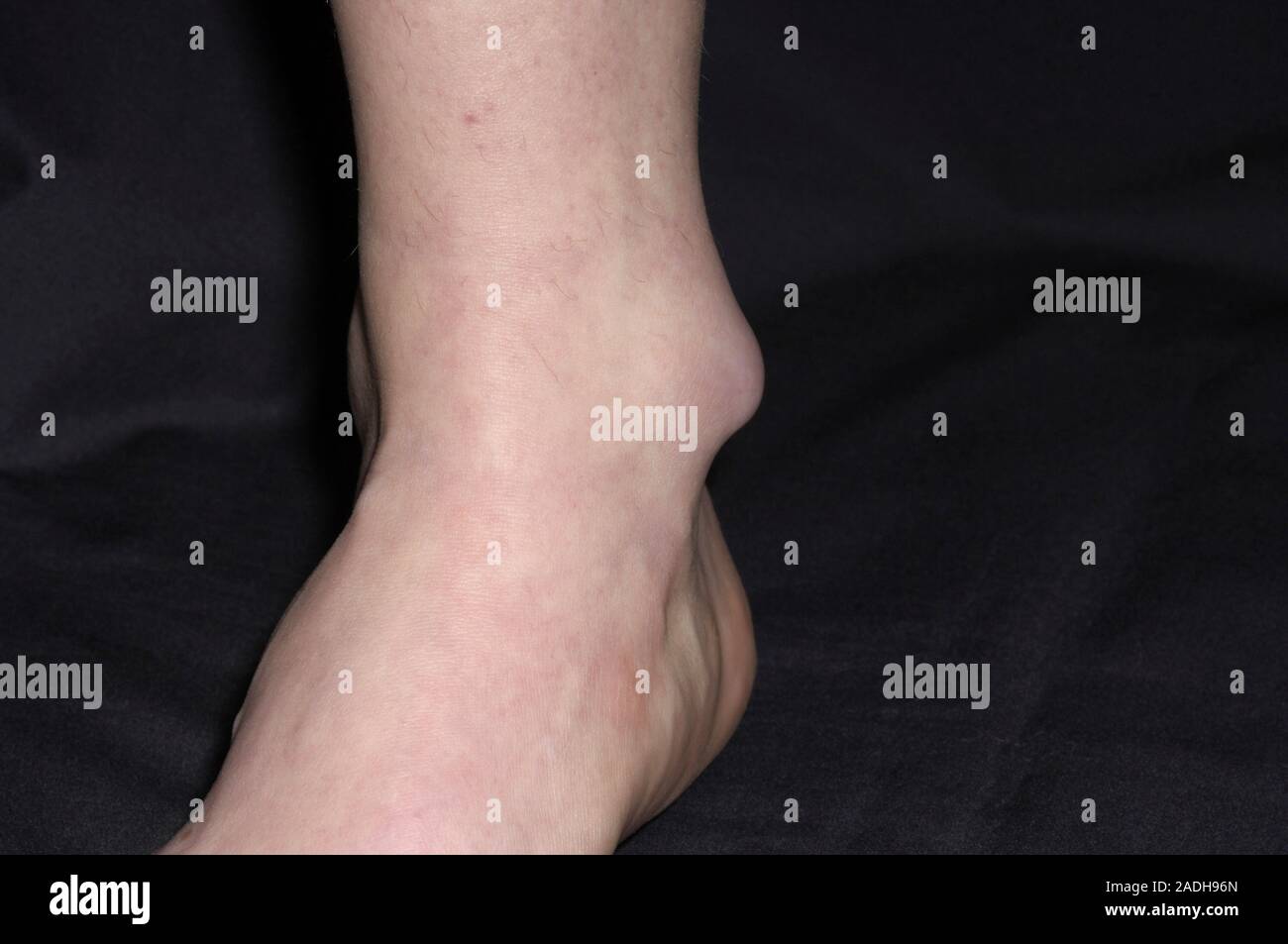 Bursitis of the ankle of a 28 year old woman. Bursitis is inflammation ...