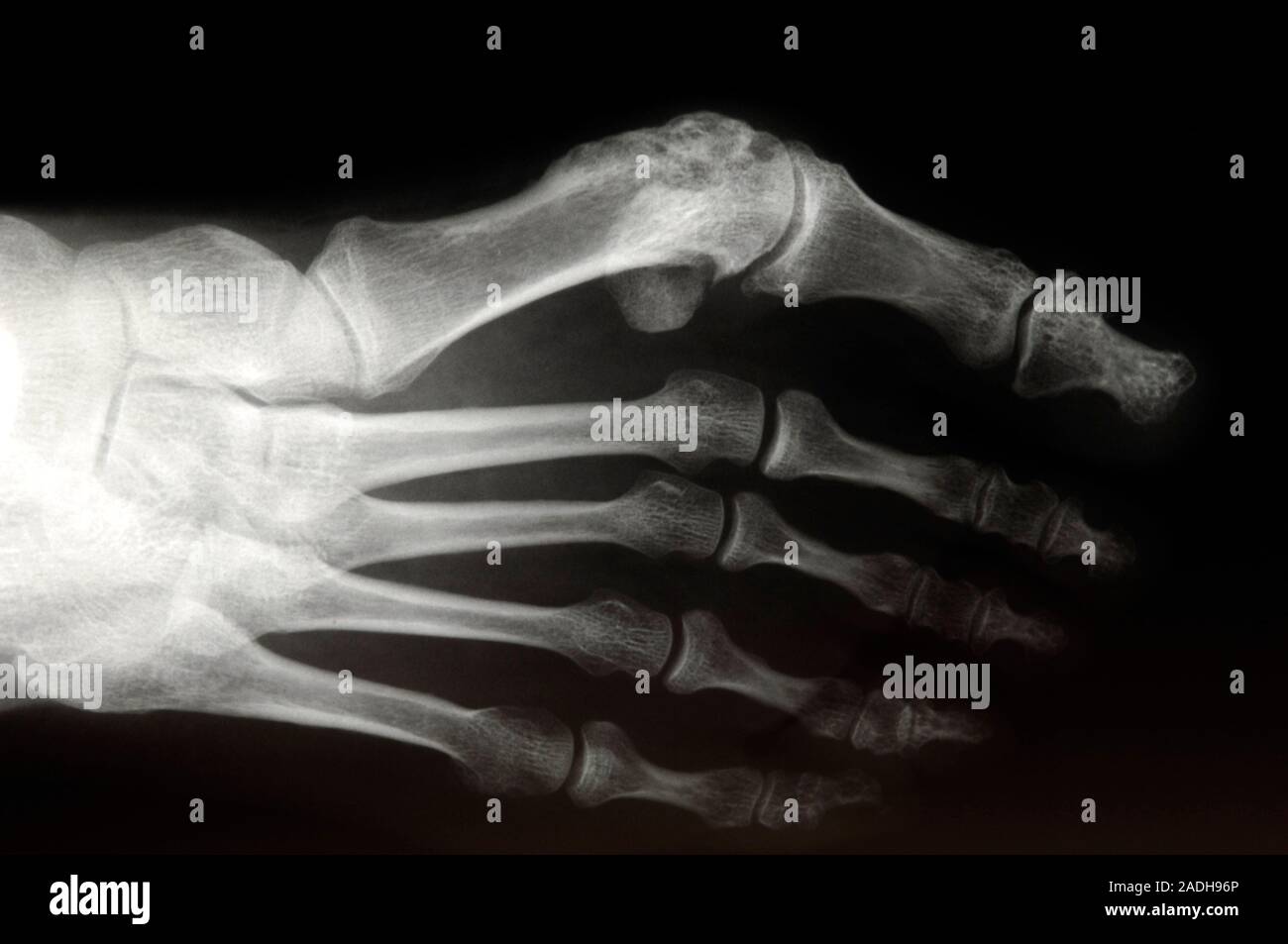 Bunion. X-ray of a bunion (hallux vulgas, white projection at upper ...
