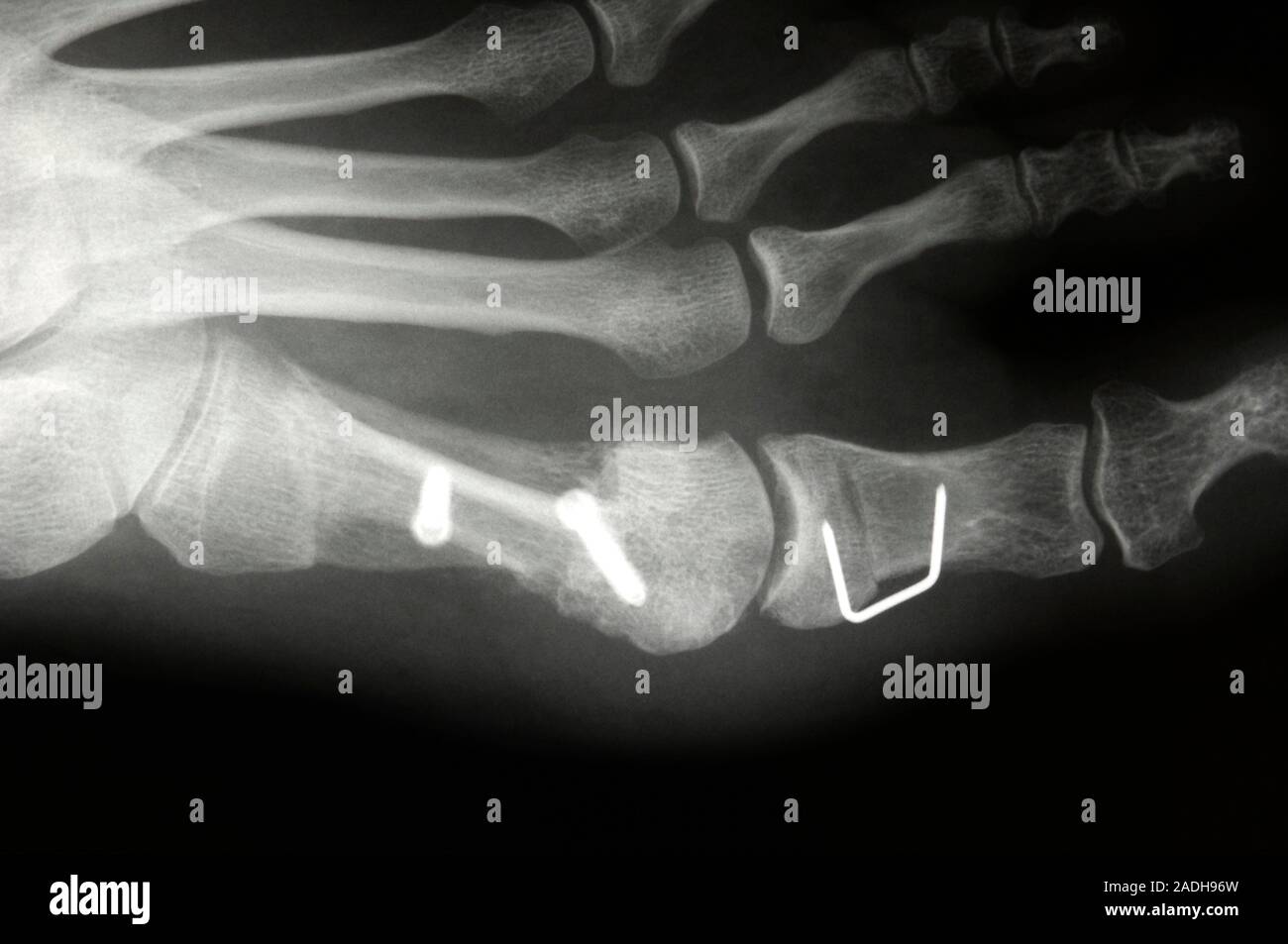Bunion treatment. X-ray of the pinned foot of a 64 year old woman that ...