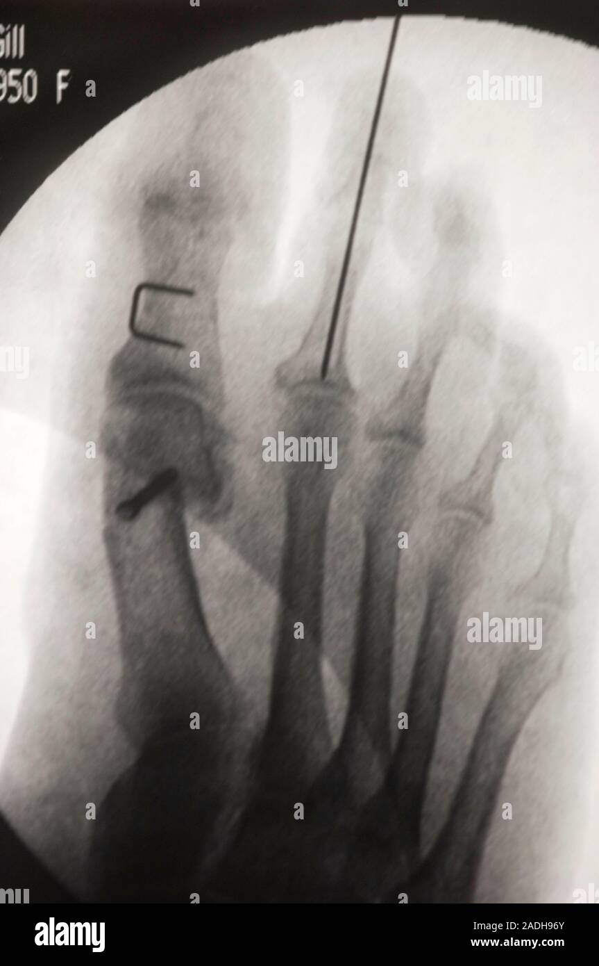 Bunion treatment. X-ray of a pinned foot that has had chevron osteotomy ...