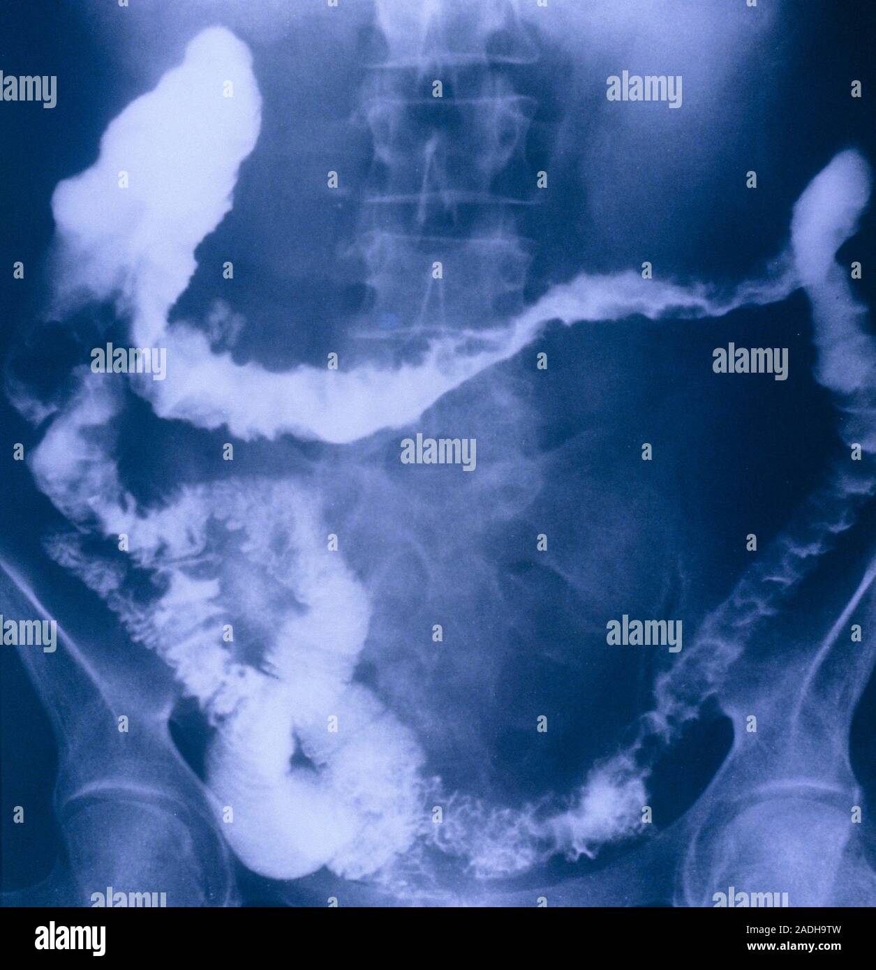 X-ray of the large intestine (colon) in chronic ulcerative colitis ...