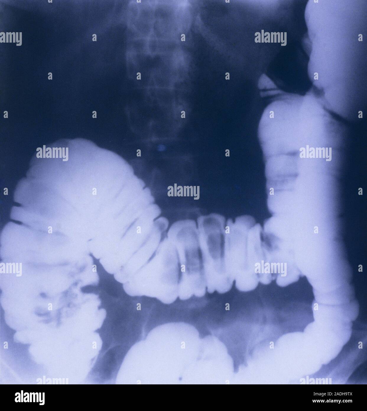 X-ray of the large intestine (colon) in ulcerative colitis. Colitis is ...