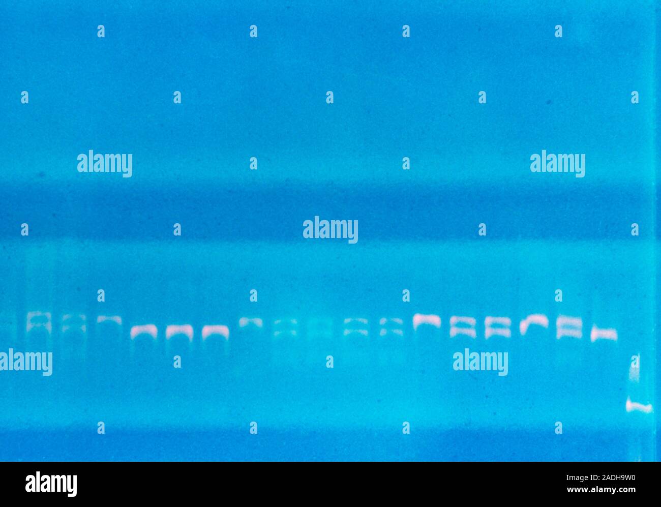 Cystic fibrosis (CF) diagnosis. Series of DNA test results from CF ...