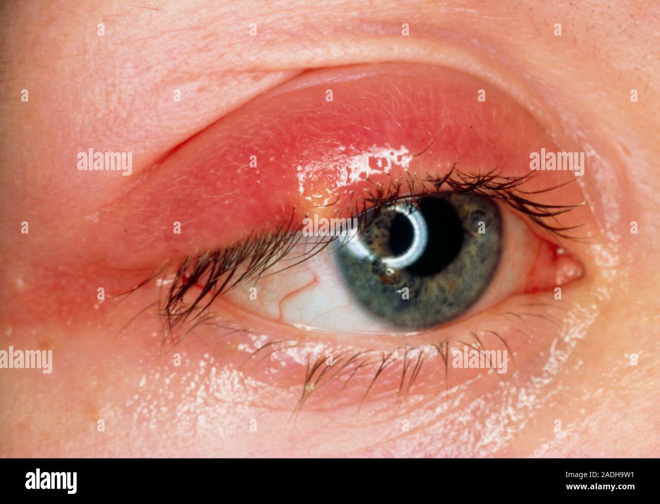A stye (medical name: hordeolum) on the upper eyelid, the result of ...