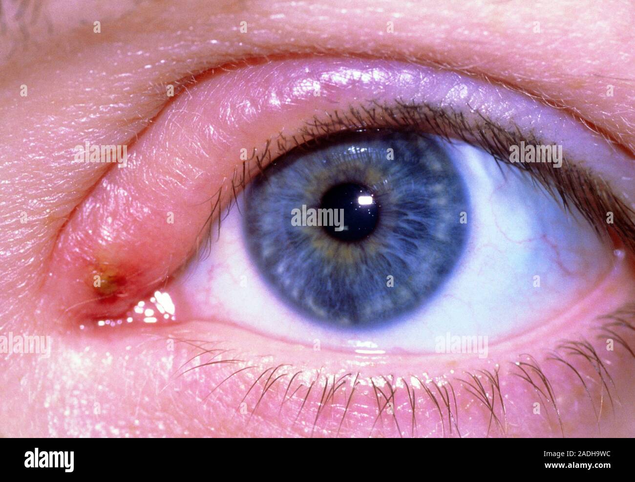 A stye (medical name: hordeolum) on the upper eyelid, the result of ...