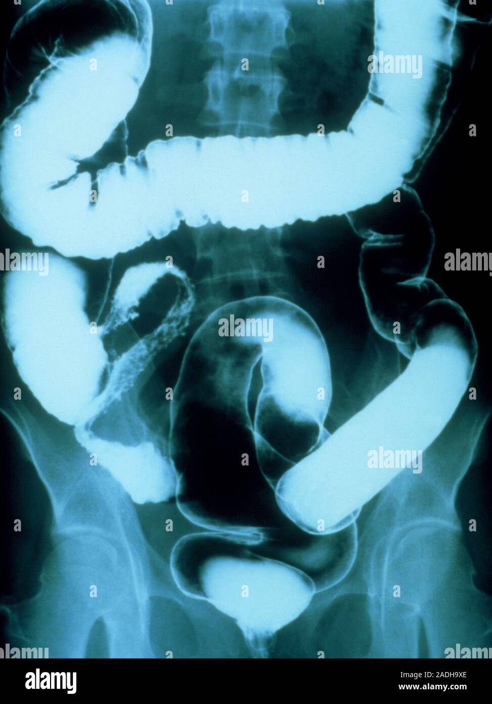Double-contrast barium X-ray showing the large intestine (colon) of a ...