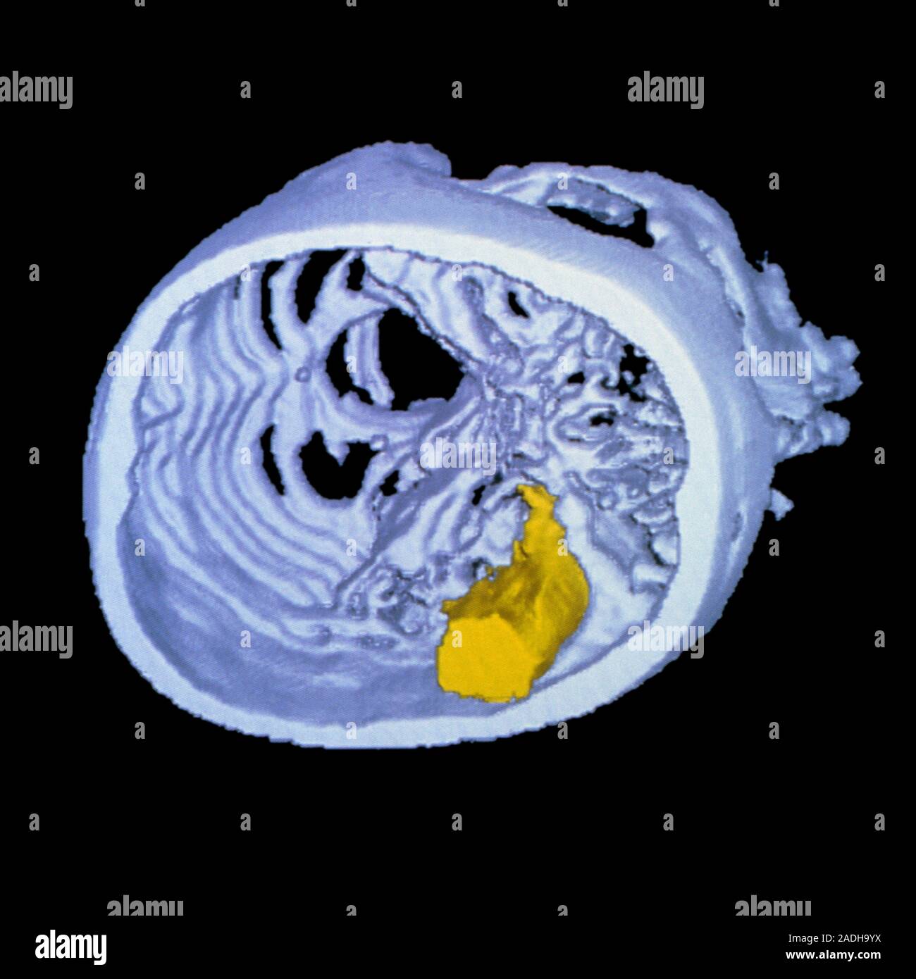 False Colour Three Dimensional Image Of The Location Of An Arachnoid Cyst Within The Vault Of