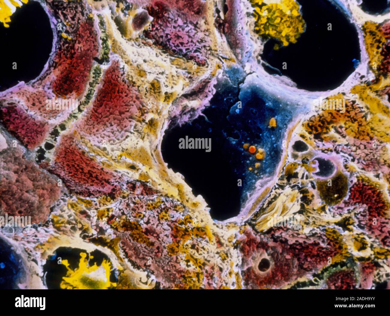 Liver cirrhosis. False-colour scanning electron micrograph (SEM) of the ...