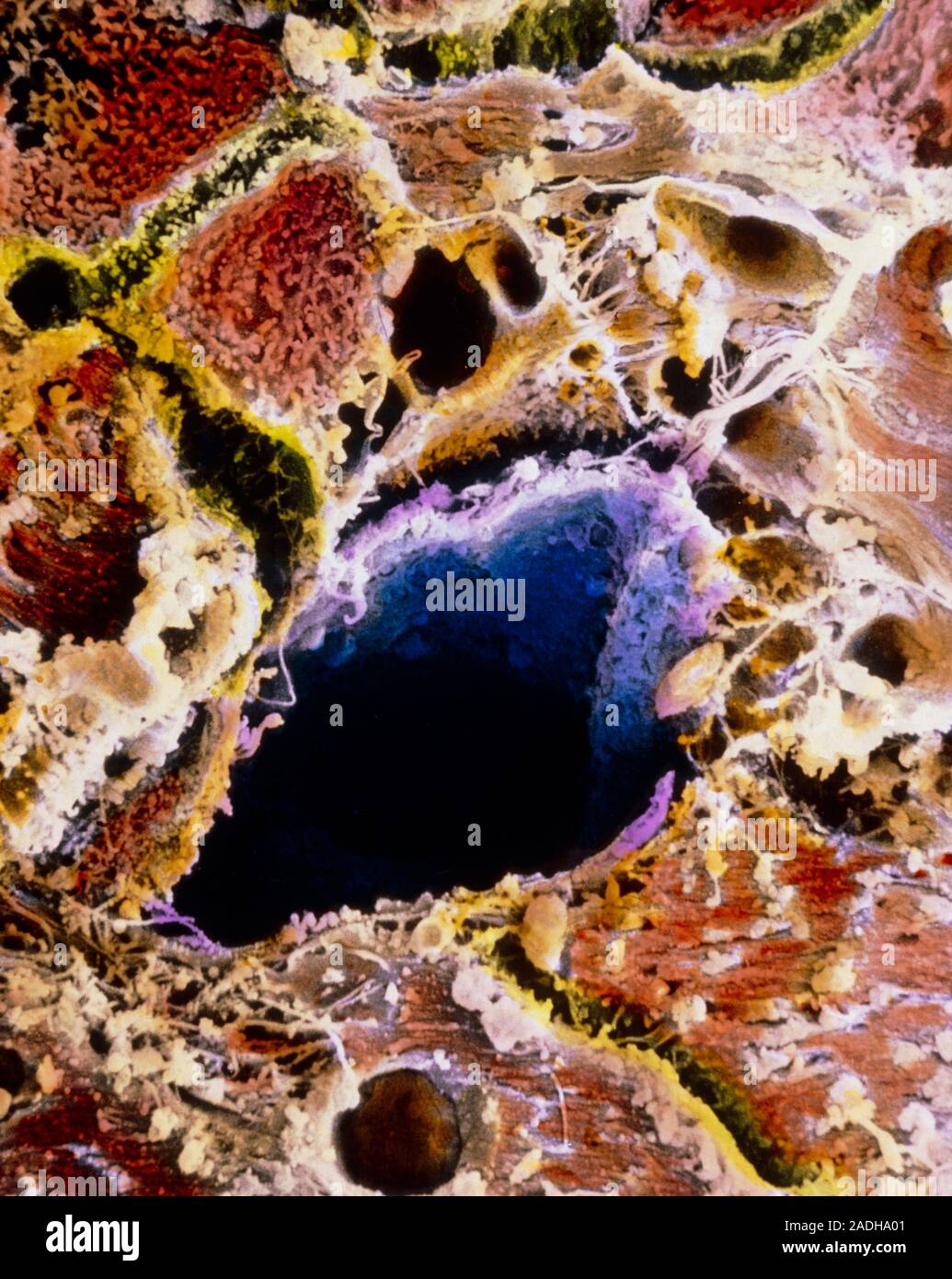 Liver cirrhosis. False-colour scanning electron micrograph (SEM) of the ...