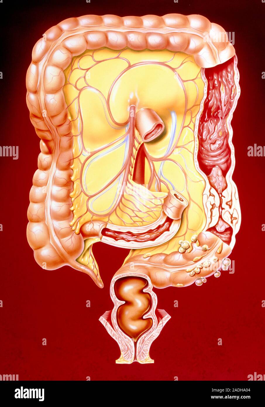 Crohn's disease, ulcerative colitis, carcinoma of the colon ...