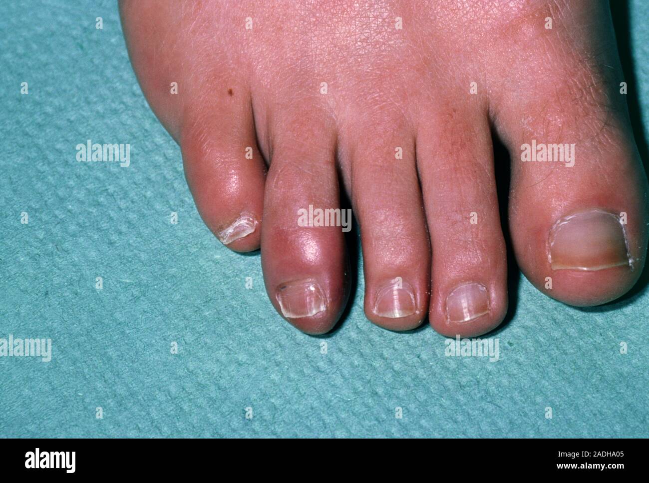 Chilblain. A patient's toe swollen to a rounded shape, red and itchy ...