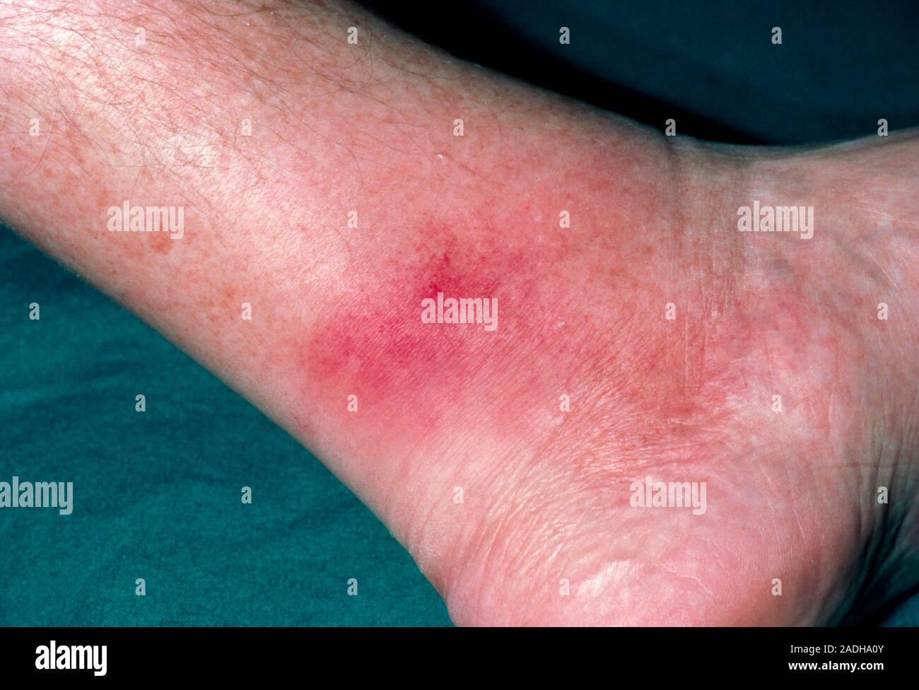Cellulitis. Close-up of the ankle of a patient suffering from the skin ...