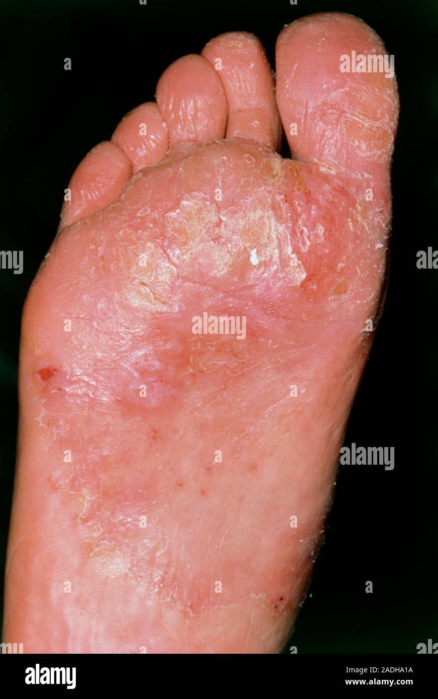 Candidiasis. Close-up of the sole of a foot affected by candidiasis, an ...