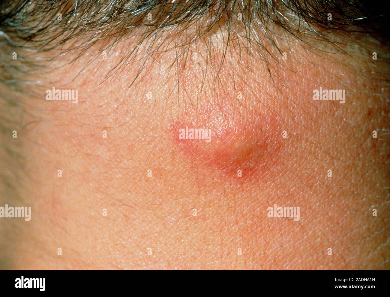 Cyst On Back Of Neck