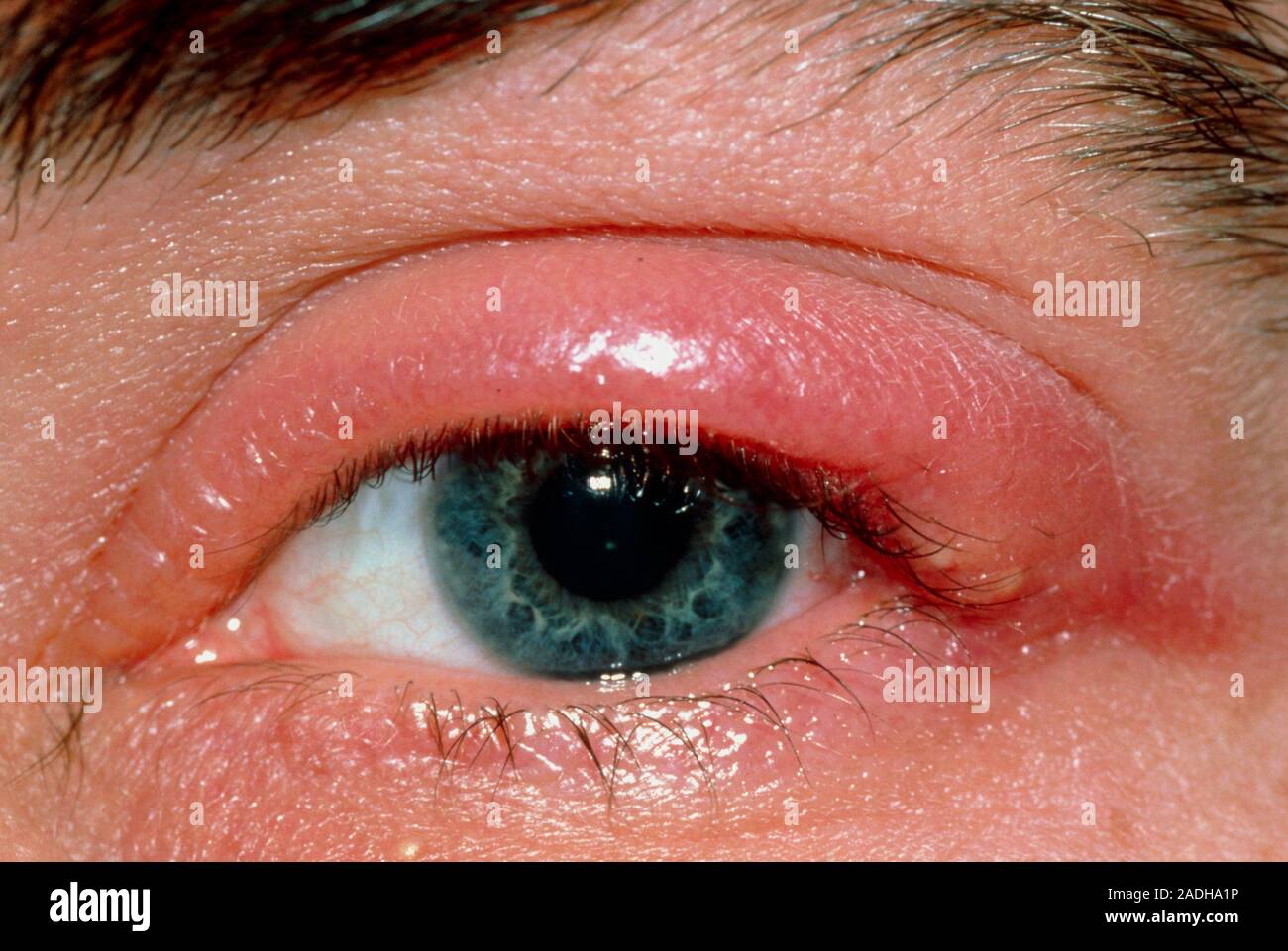 Hordeolum or stye on eyelid. Close-up of an inflamed and reddened upper ...