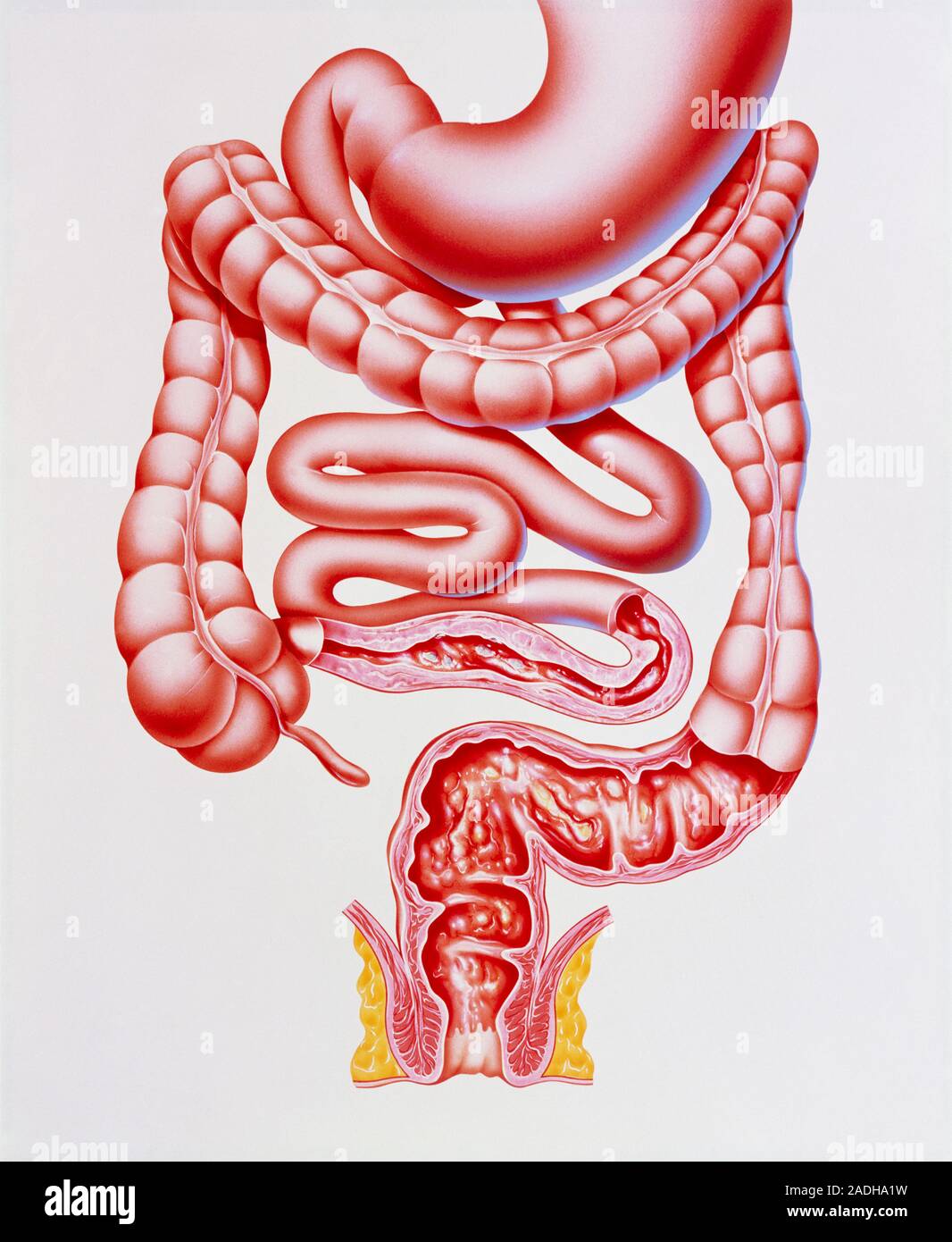 Crohn's disease and ulcerative colitis. Artwork of the human digestive ...