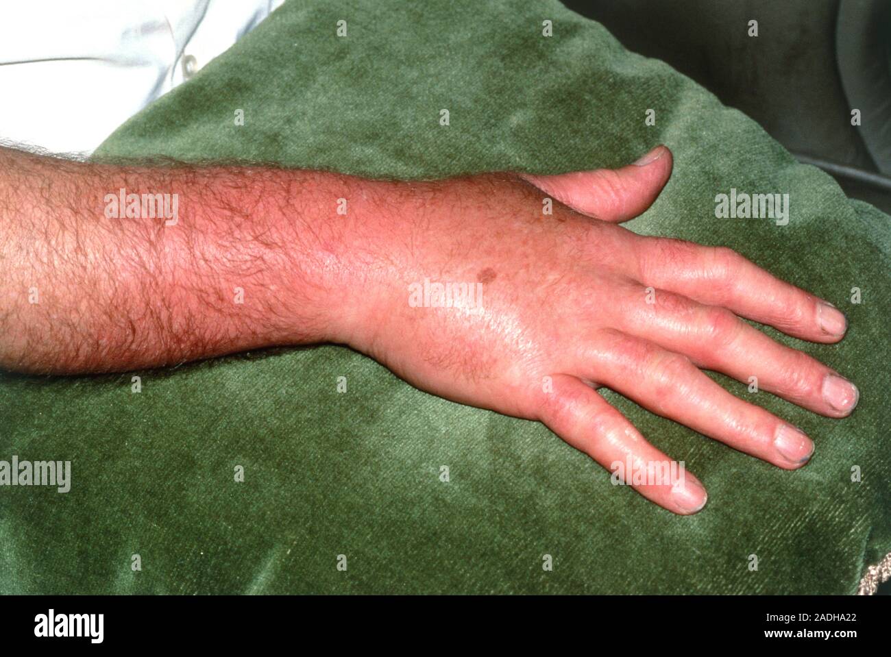Cellulitis. View of swelling and inflammation on a man's hand due to ...
