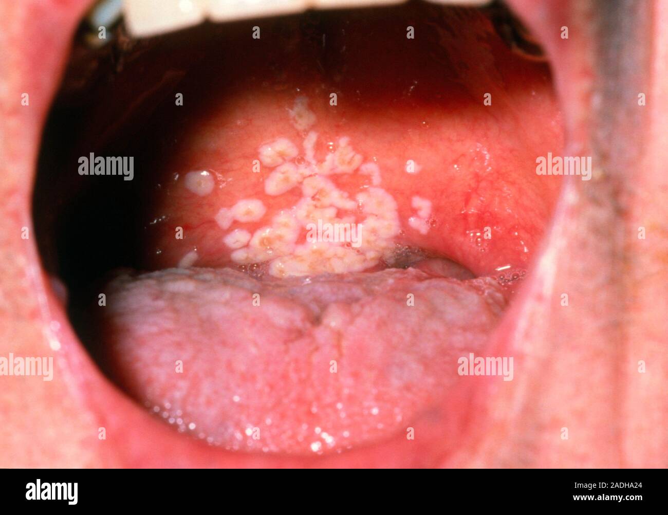 Oral thrush. View of a mouth showing an infection caused by the yeast like fungus Candida albicans. The soft palate uvula are covered with small wh Stock Photo Alamy