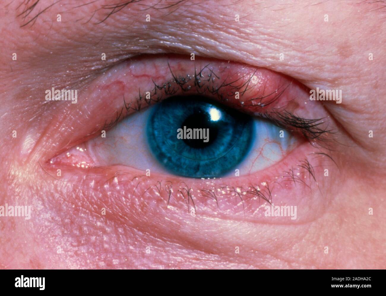 Stye. Close-up of a patient's left eye, showing a stye (hordeolum) on ...