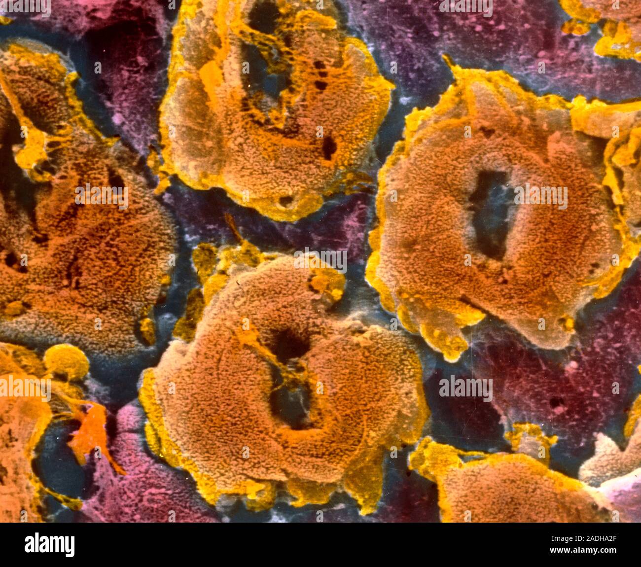 Ulcerative colitis. Coloured Scanning Electron Micrograph (SEM) of the ...
