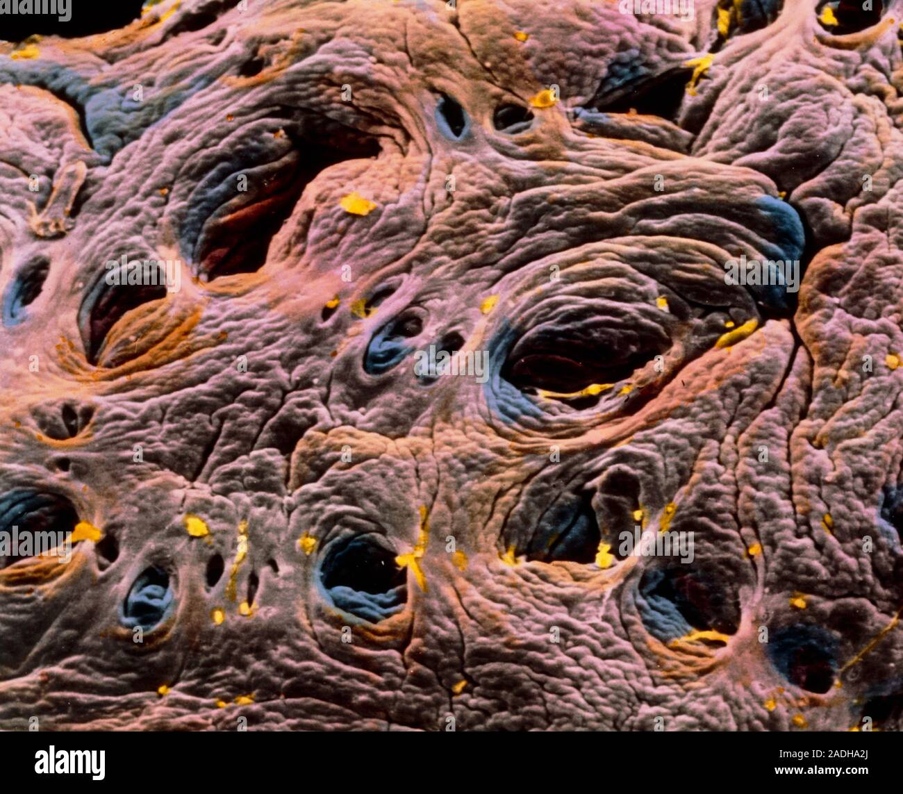 Coeliac disease. Coloured Scanning Electron Micrograph (SEM) of the ...