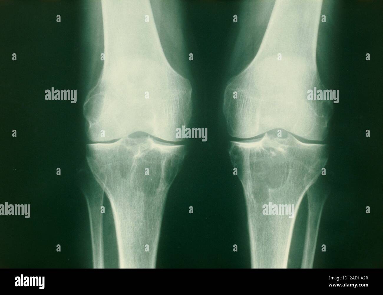 Bakers Cysts Of Knee X Ray Of The Knees Of A Patient With Cysts Caused By Rheumatoid Arthritis