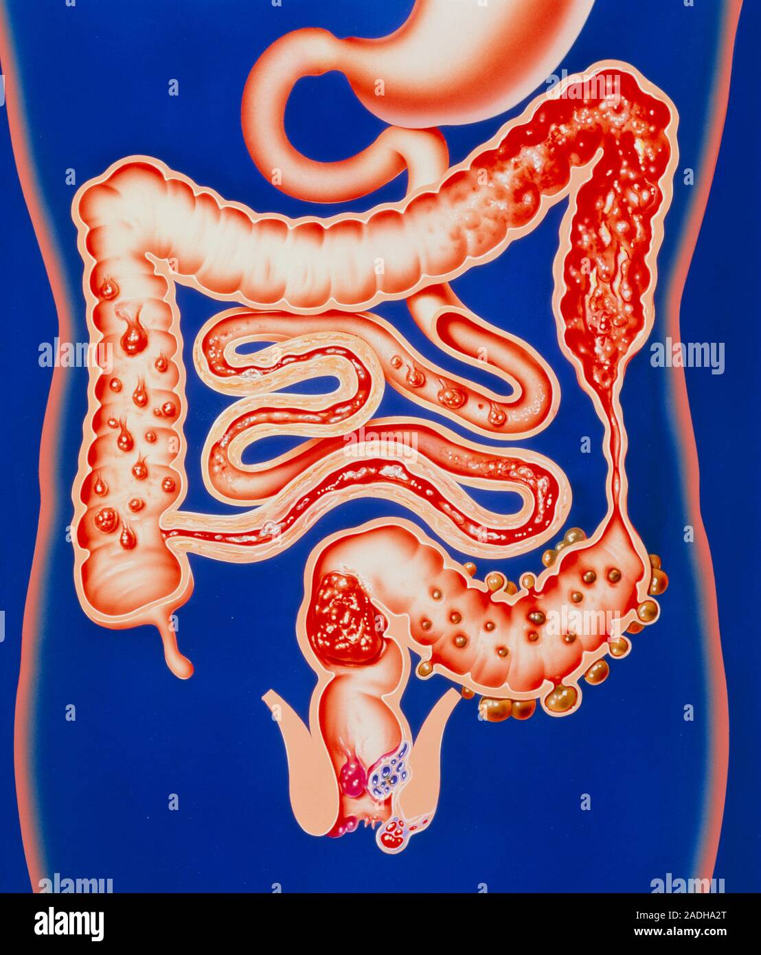 Intestinal disorders. Illustration showing Crohns disease, polyps ...