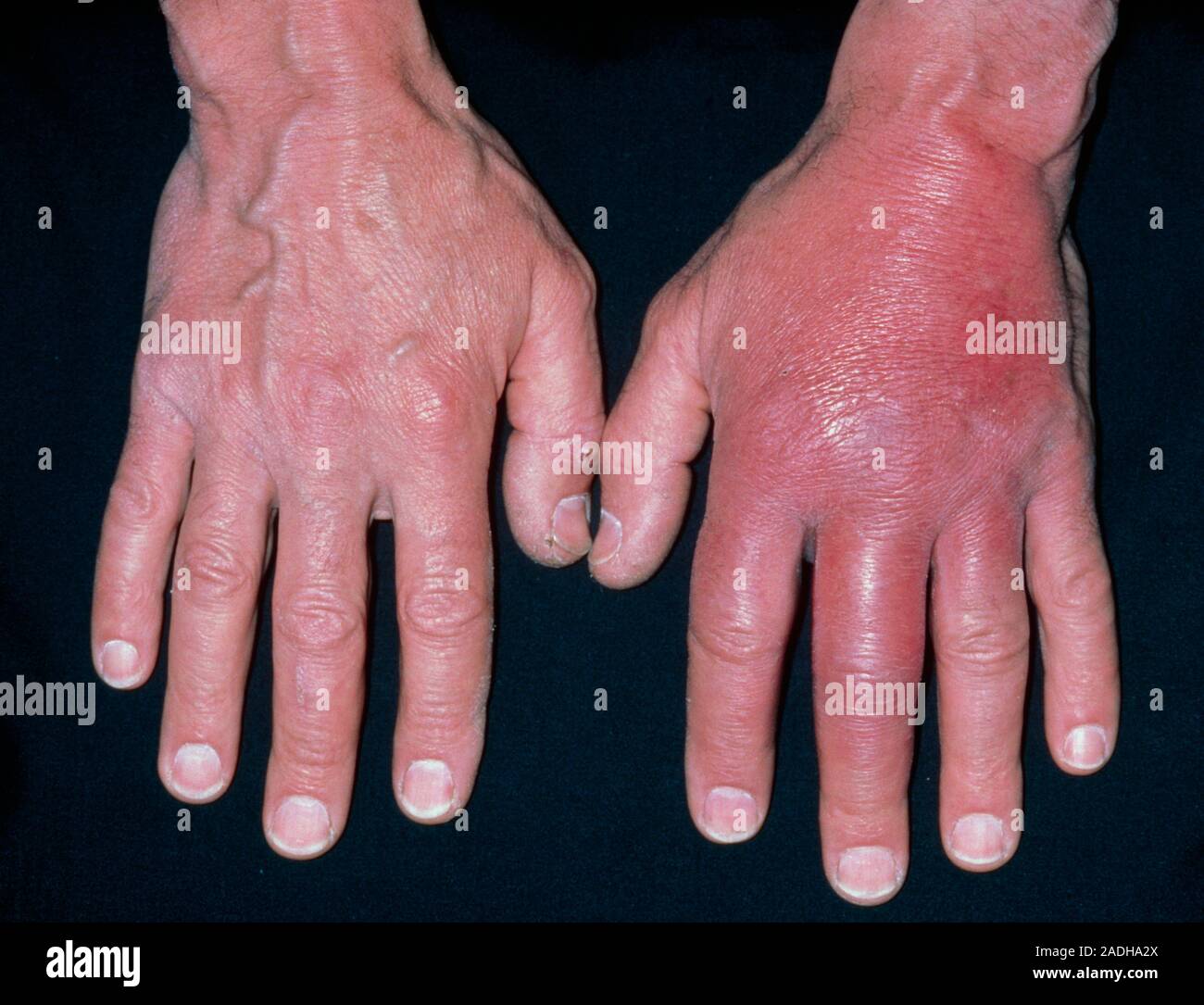 Cellulitis in a patient's hand, causing redness & inflammation over a ...