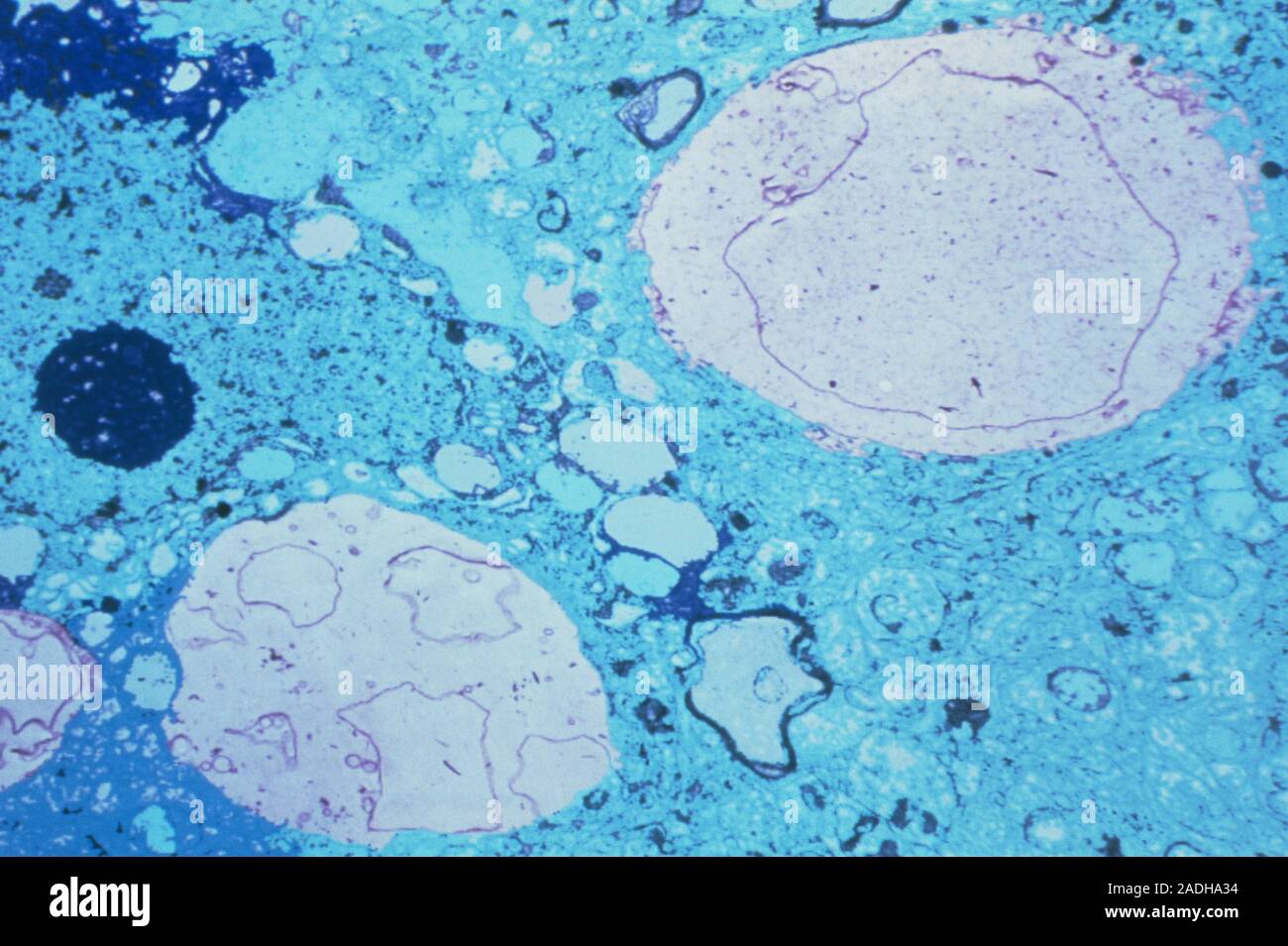 Creutzfeldt-Jakob disease. Light micrograph of a section through human ...