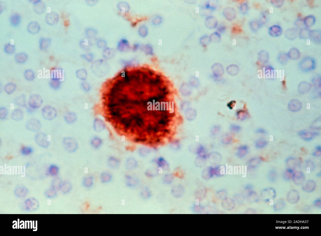Creutzfeldt-Jakob disease. Light micrograph of a section through human ...