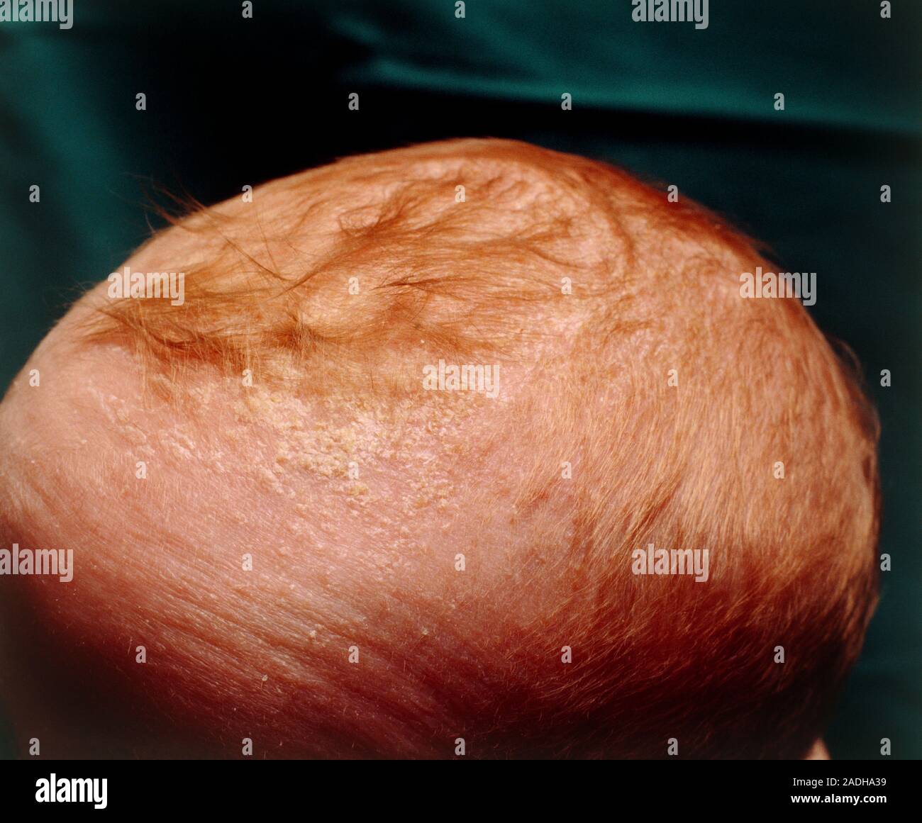 Cradle cap. Close-up of the top of the head of an eight week-old infant ...