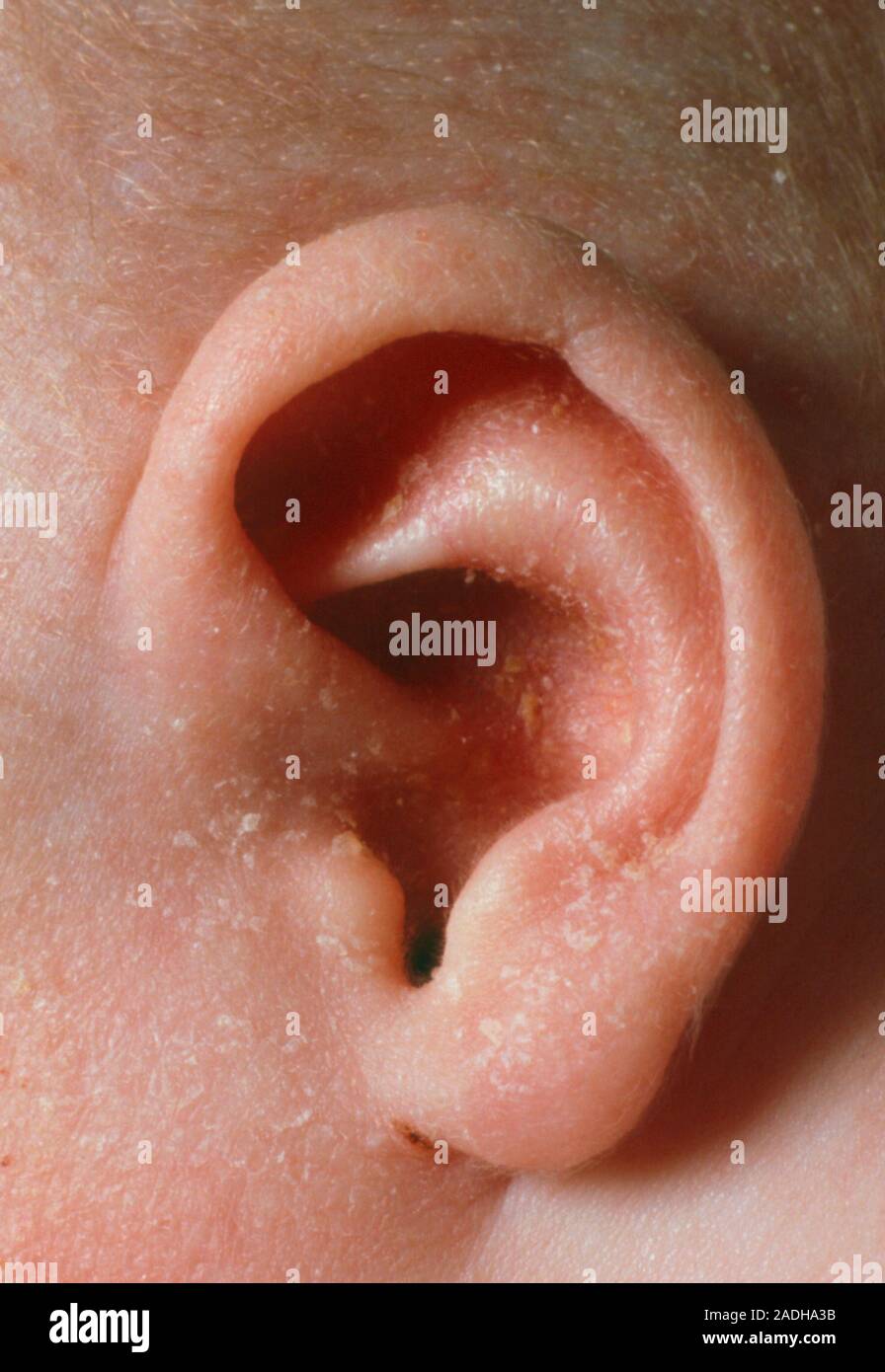Cradle cap on ears store
